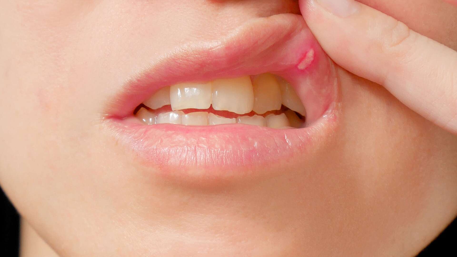 Sinais que indicam câncer na boca – Odonto Excellence